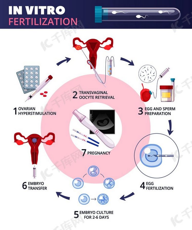 彩色扁平体外受精 IVF 信息图表，包括从卵巢刺激到怀孕的步骤 向量例证背景图片免费下载_海报banner/高清大图_千库网(图片编号6283405)