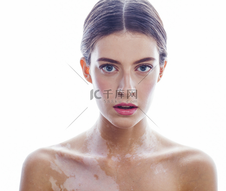beautiful young brunette woman with vitiligo disease isolated on white ...