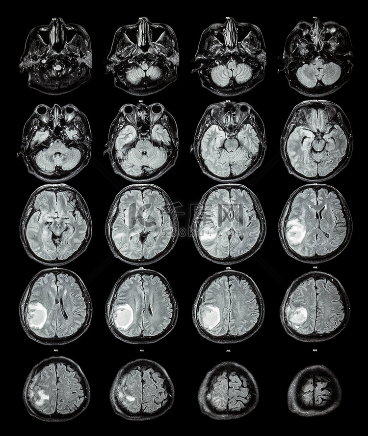 MRI 大脑：右顶叶的脑肿瘤高清摄影大图-千库网