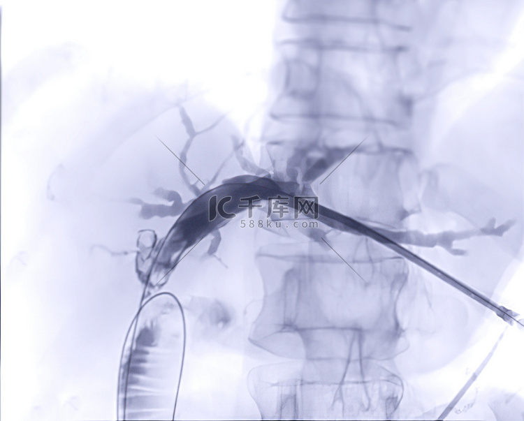 医生在现代手术室内进行 ERCP 和腹腔镜胆囊切除术后门静脉的 X 射线图像。高清摄影大图-千库网