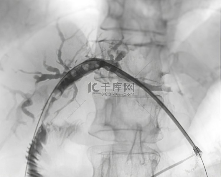 医生在现代手术室内进行 ERCP 和腹腔镜胆囊切除术后门静脉的 X 射线图像。高清摄影大图-千库网