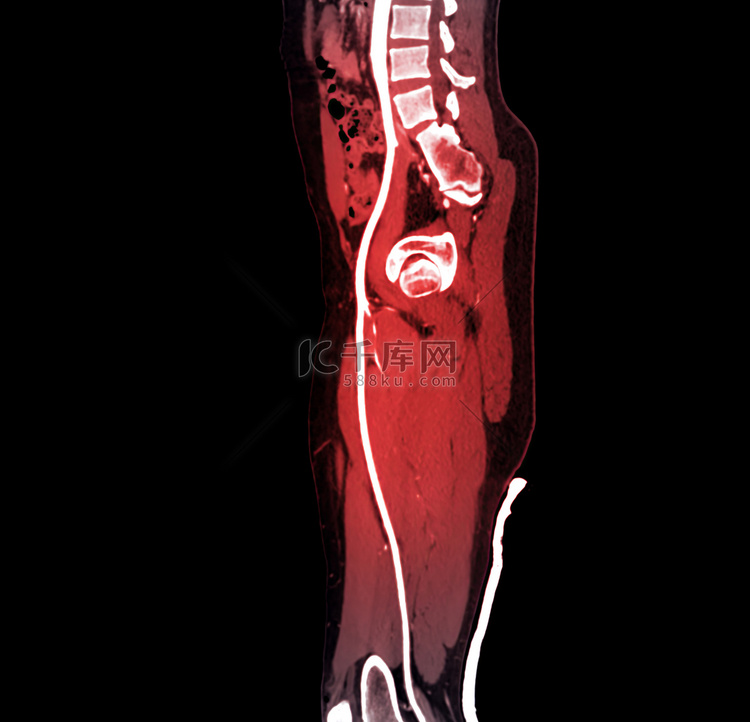 CTA股动脉跑出MPR曲线。高清摄影大图-千库网