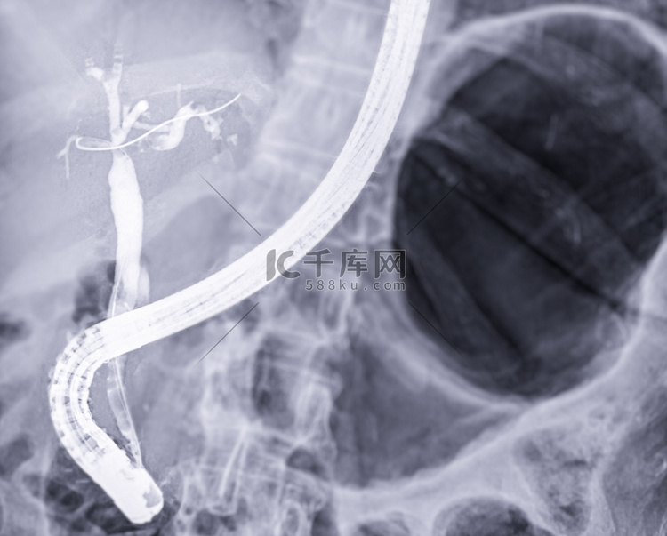 医生在现代手术室内进行 ERCP 和腹腔镜胆囊切除术后的内窥镜 X 射线图像。高清摄影大图-千库网