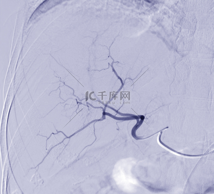 TACE 或化疗栓塞术的成像是一种允许将一定剂量的化疗药物直接施用于显示肝动脉的肝肿瘤或 HCC 的程序。高清摄影大图-千库网