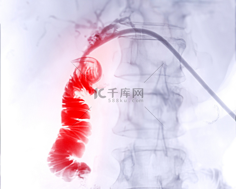 医生在现代手术室内进行 ERCP 和腹腔镜胆囊切除术后门静脉的 X 射线图像。高清摄影大图-千库网