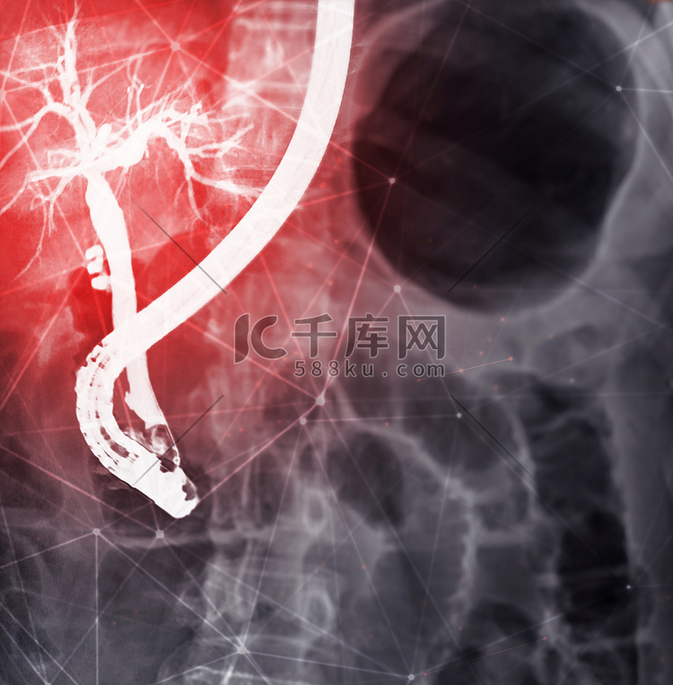 医生在现代手术室内进行 ERCP 和腹腔镜胆囊切除术后的内窥镜 X 射线图像。高清摄影大图-千库网