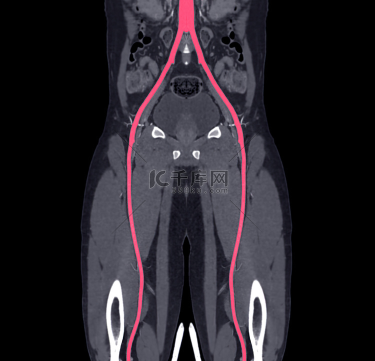 CTA股动脉跑出MPR曲线。高清摄影大图-千库网