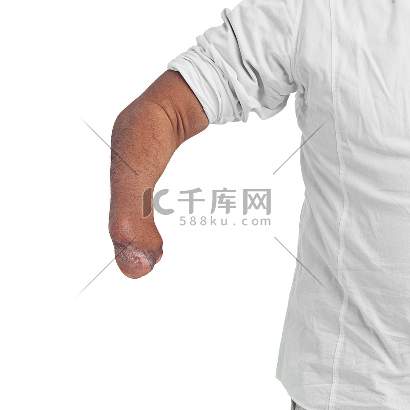 一名男子的残疾、独特和手臂截肢者，用模型显示前臂受伤。高清摄影大图 千库网