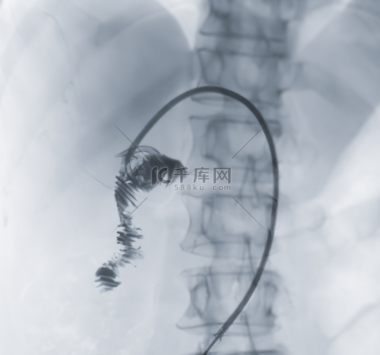医生在现代手术室内进行 ERCP 和腹腔镜胆囊切除术后门静脉的 X 射线图像。高清摄影大图-千库网