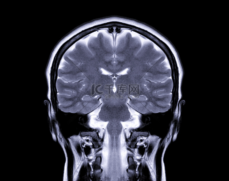 MRI 脑冠状 t2W 视图用于检测大脑的各种状况，例如屏幕上孤立的囊肿、肿瘤、出血。高清摄影大图-千库网