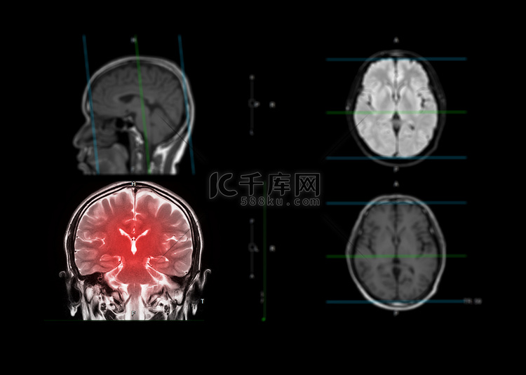 大脑 MRI 显示大脑的冠状面。高清摄影大图-千库网