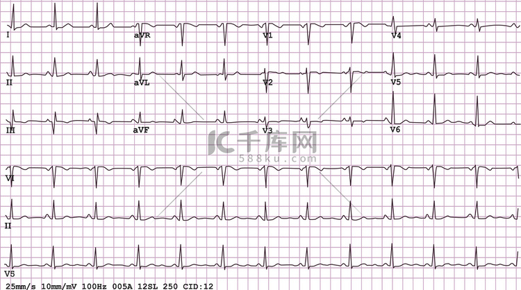 12 导联心电图高清摄影大图-千库网
