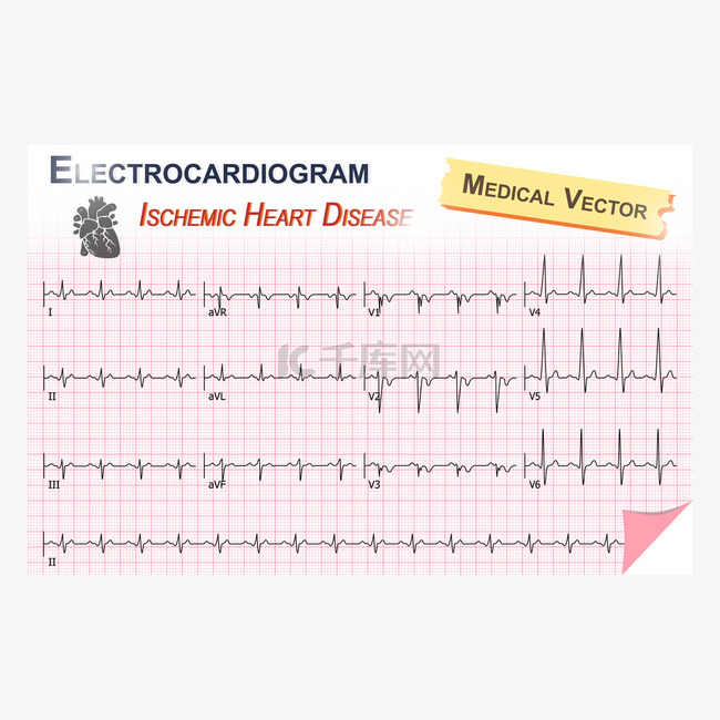 心电图 (Ecg、 心电图) 的缺血性心脏病 (心肌梗死) 和解剖的心脏图标素材图片免费下载-千库网
