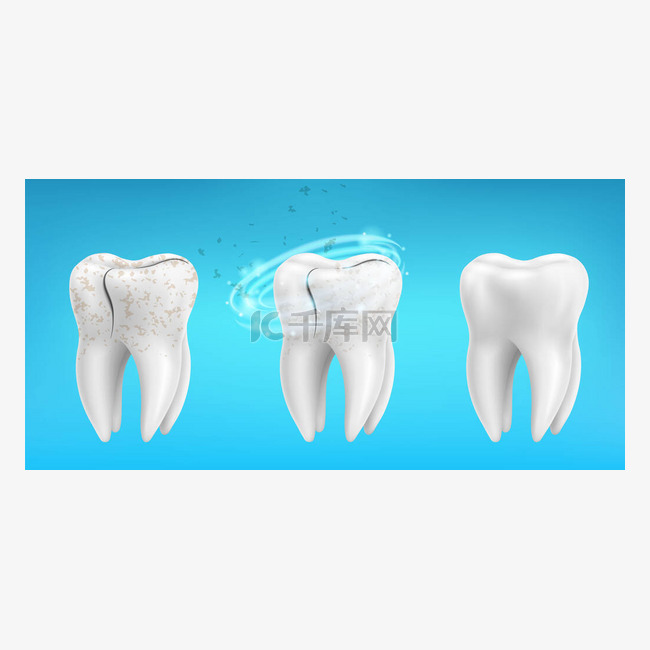 3d realistic clean and dirty tooth set on blue background, Teeth ...